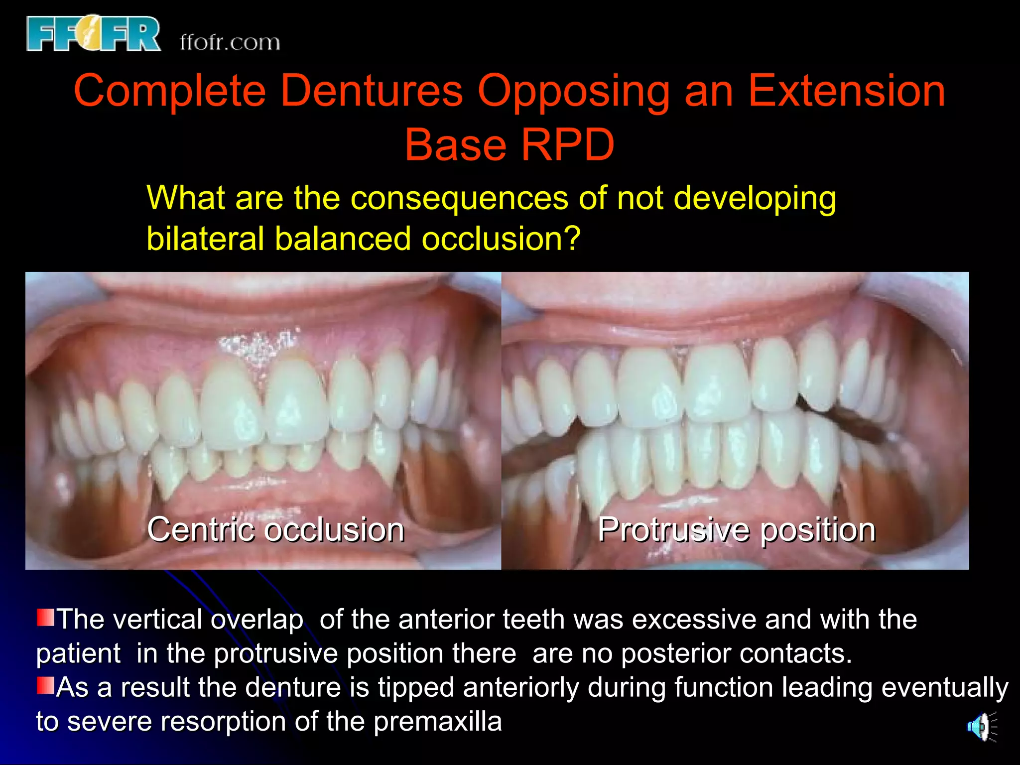 10.maxillo mandibular records | PPT