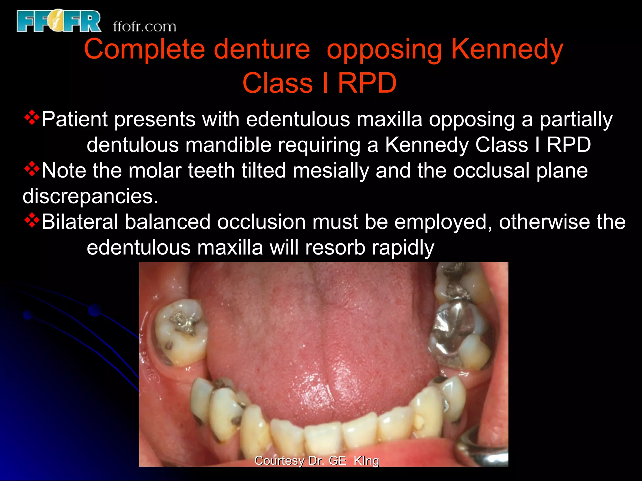 10.maxillo mandibular records | PPT