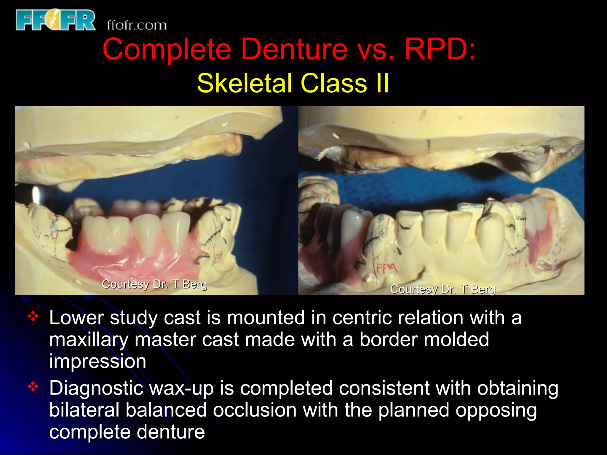 10.maxillo mandibular records | PPT