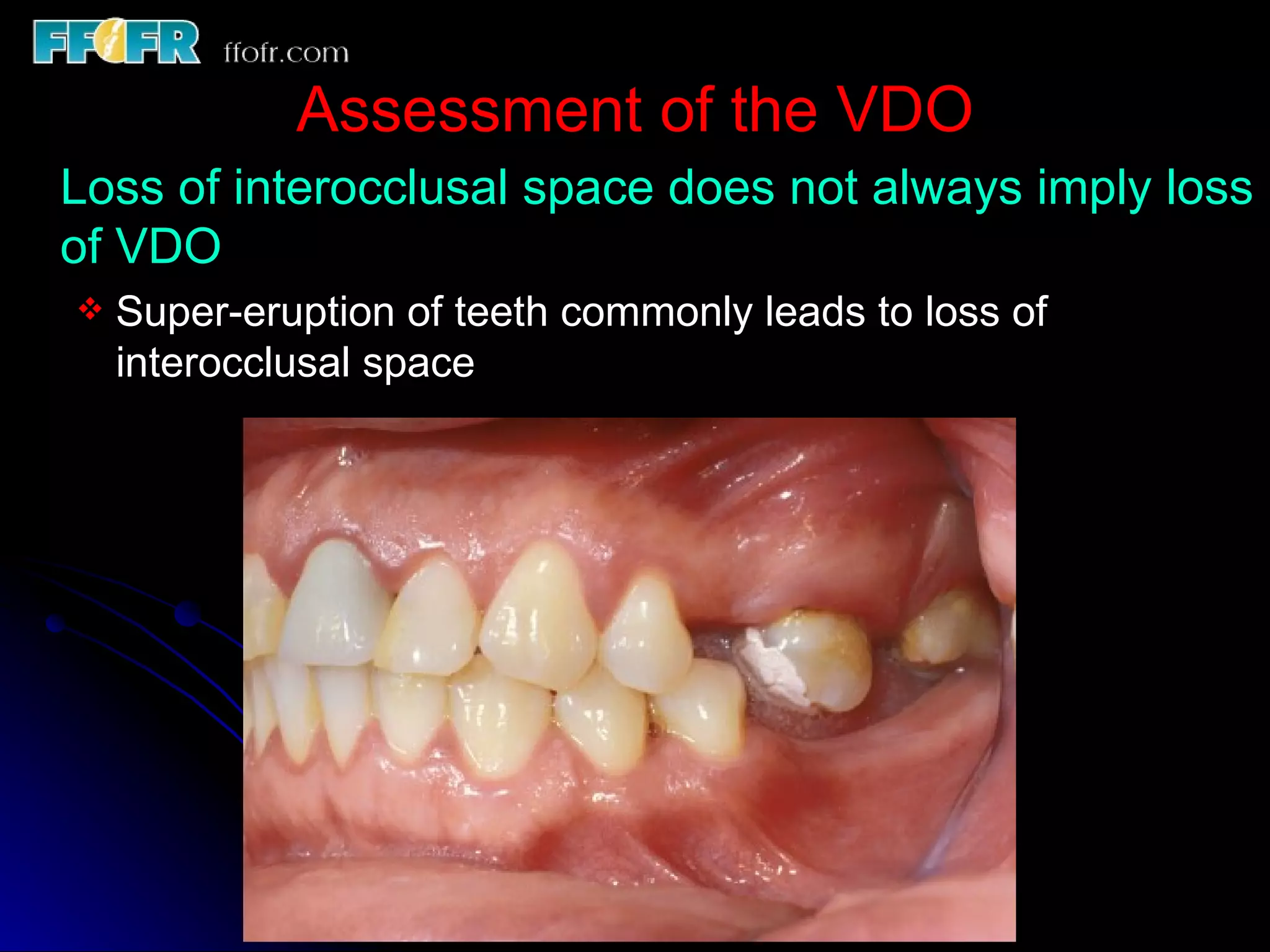 10.maxillo mandibular records | PPT