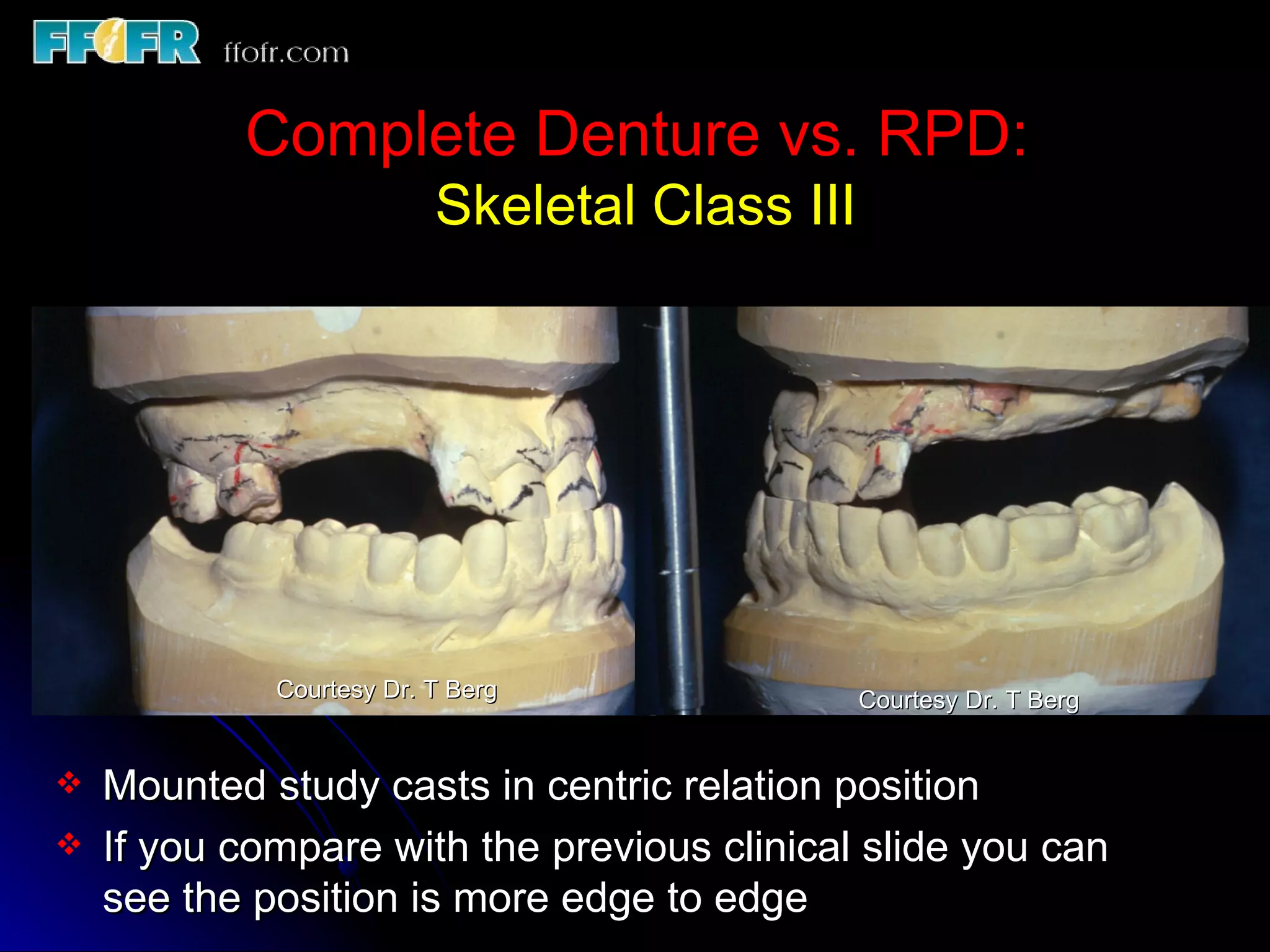 10.maxillo mandibular records | PPT
