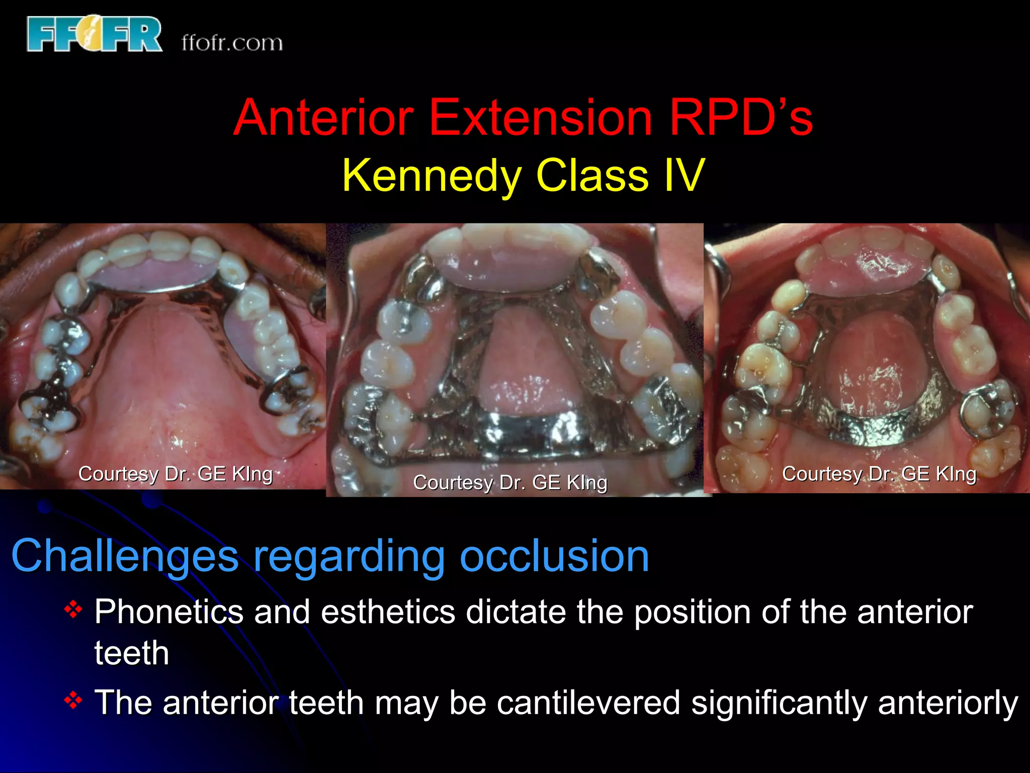 10.maxillo mandibular records | PPT