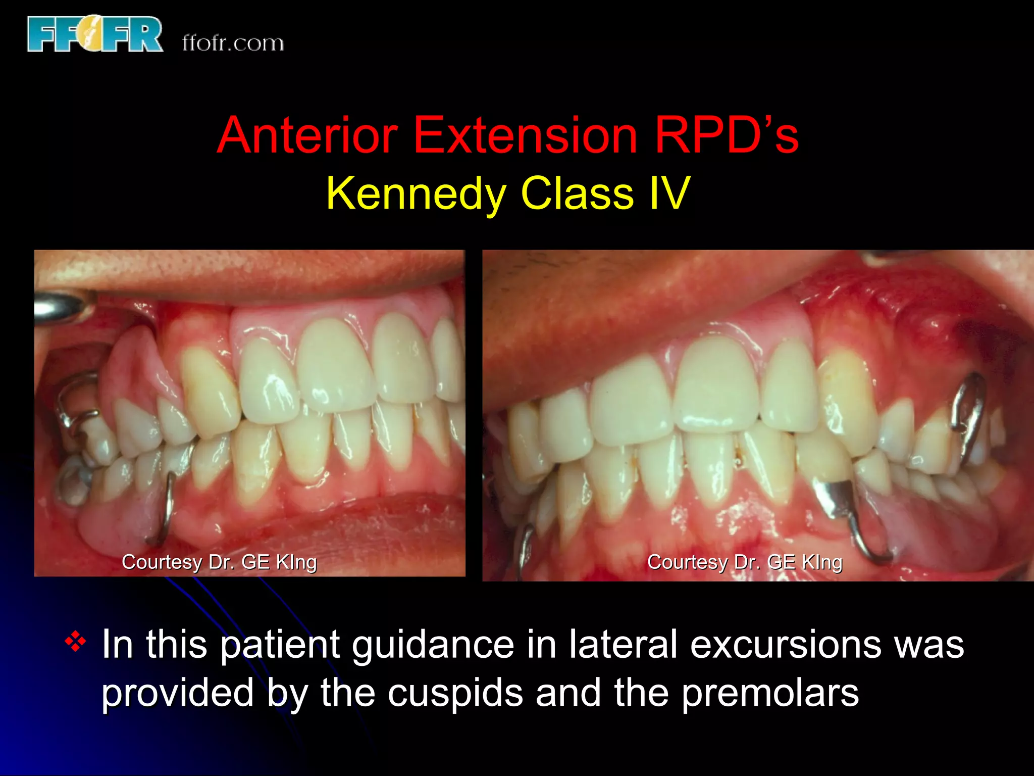 10.maxillo mandibular records | PPT