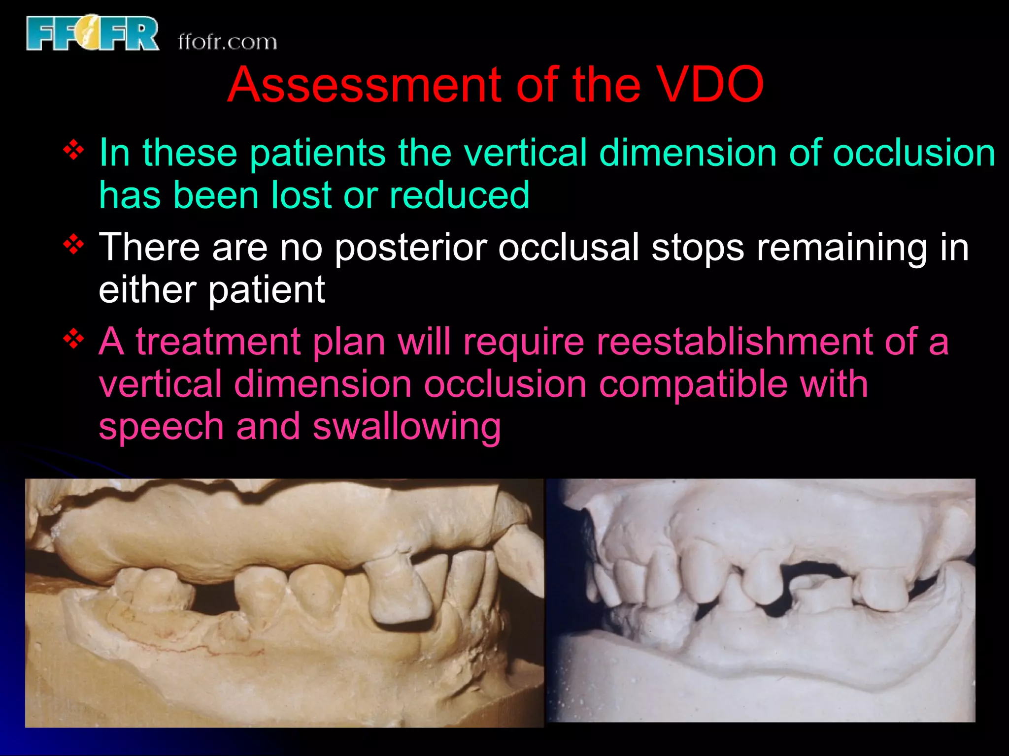 10.maxillo mandibular records | PPT