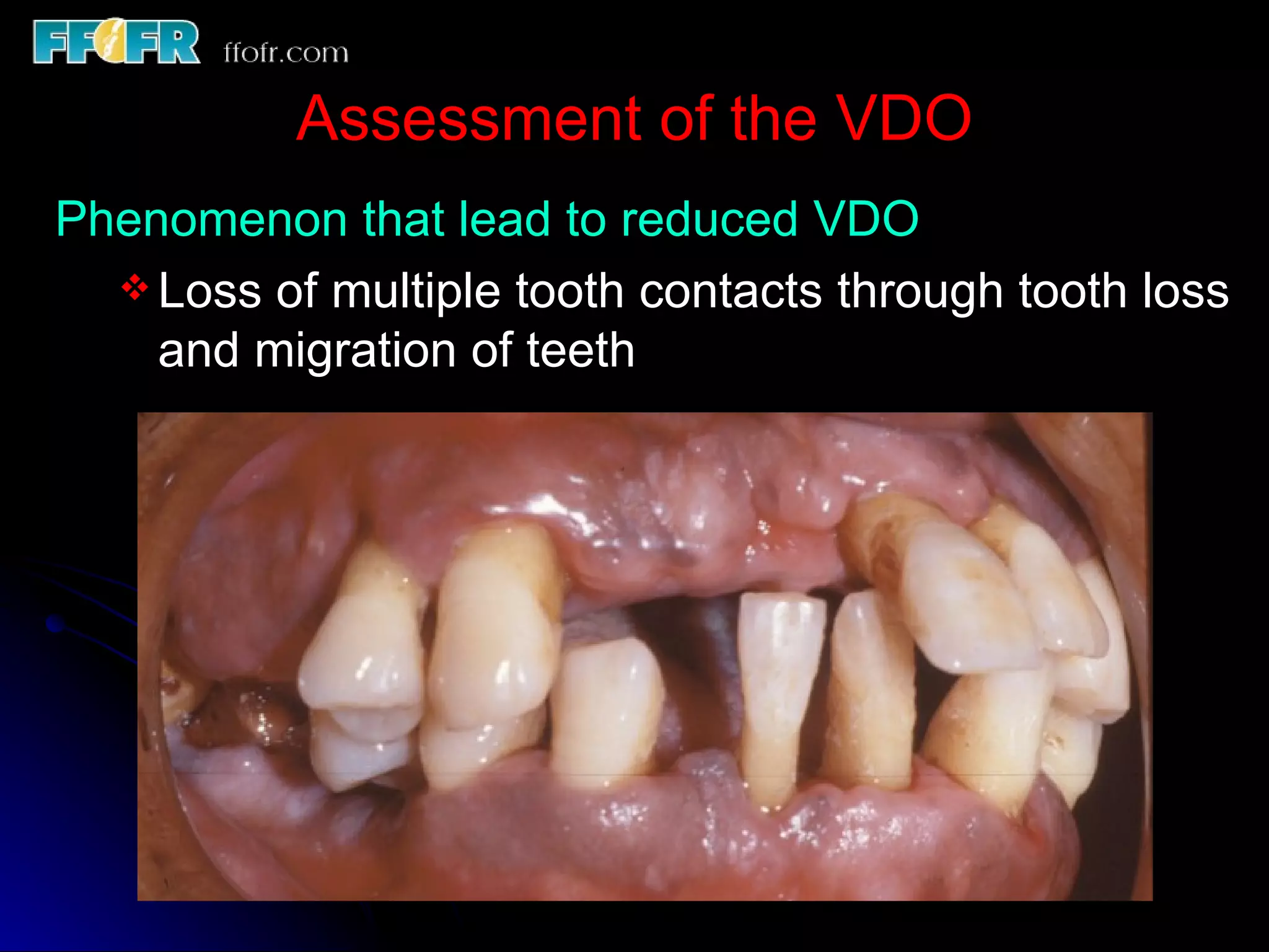 10.maxillo mandibular records | PPT