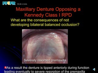 10.maxillo mandibular records | PPT