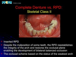 10.maxillo mandibular records | PPT