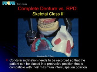 10.maxillo mandibular records | PPT