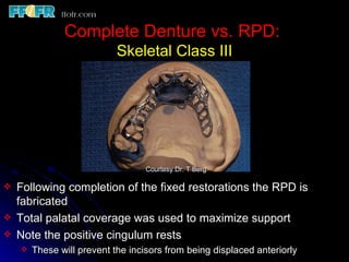10.maxillo mandibular records | PPT