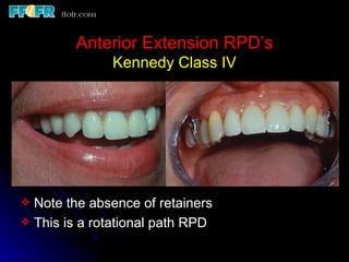 10.maxillo mandibular records | PPT
