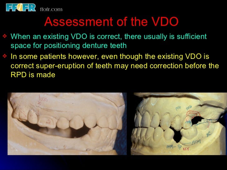 10.maxillo mandibular records