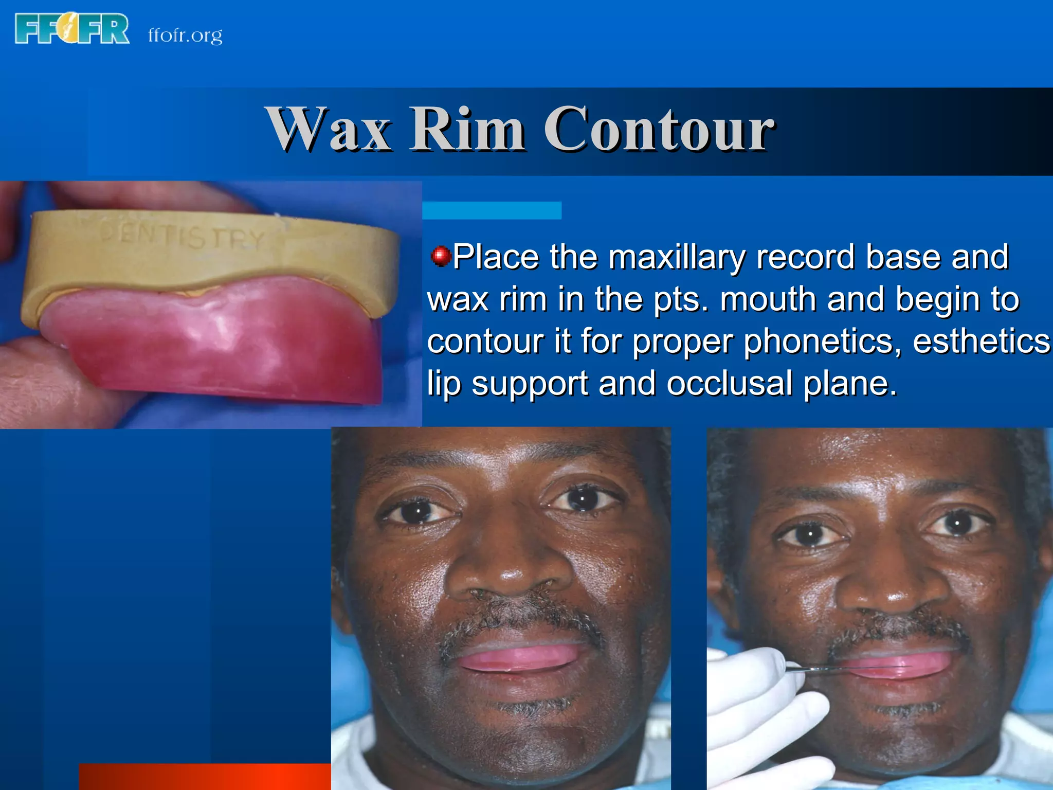 10.maxillomandibular relation records | PPT