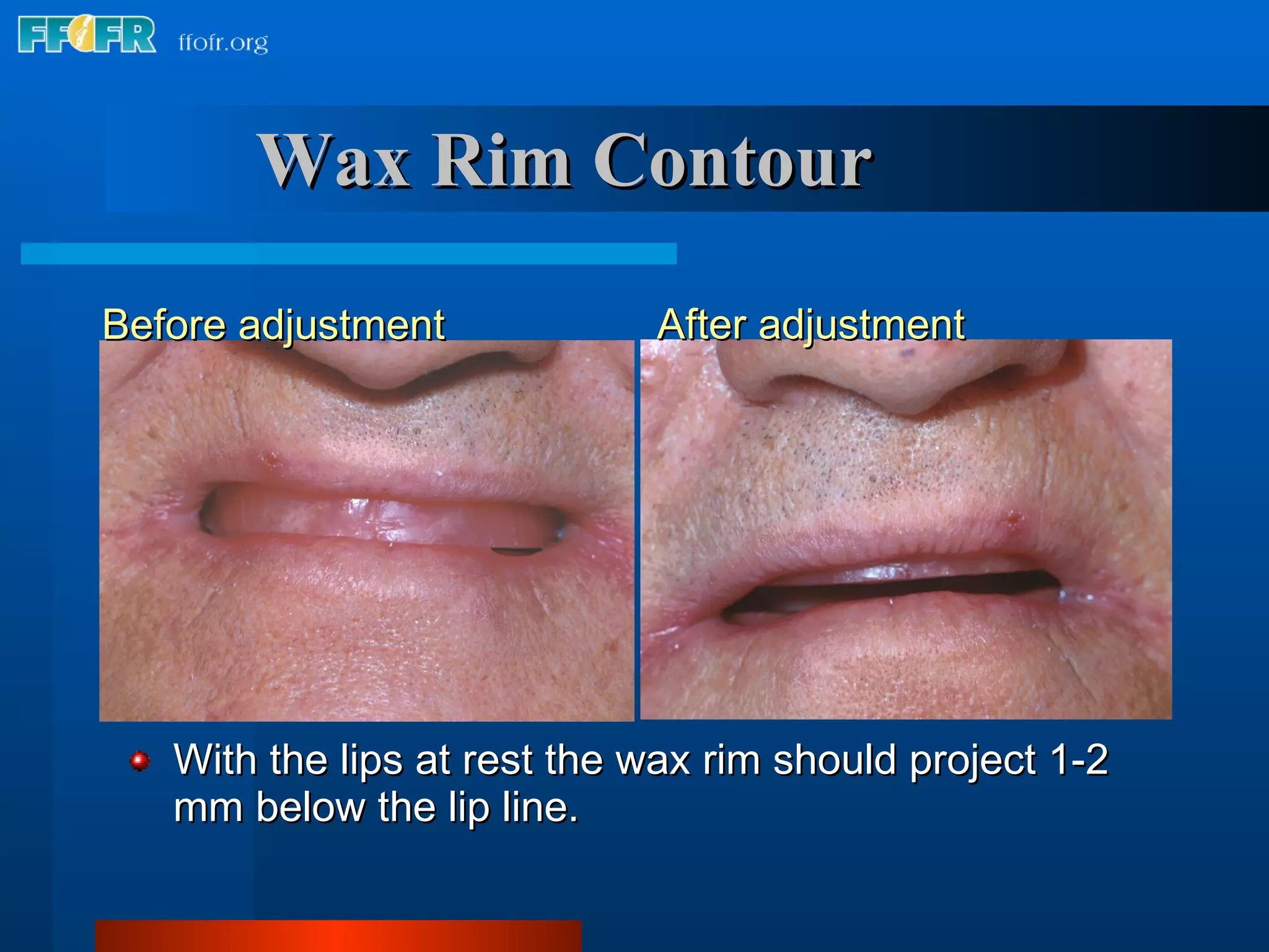 10.maxillomandibular relation records | PPT