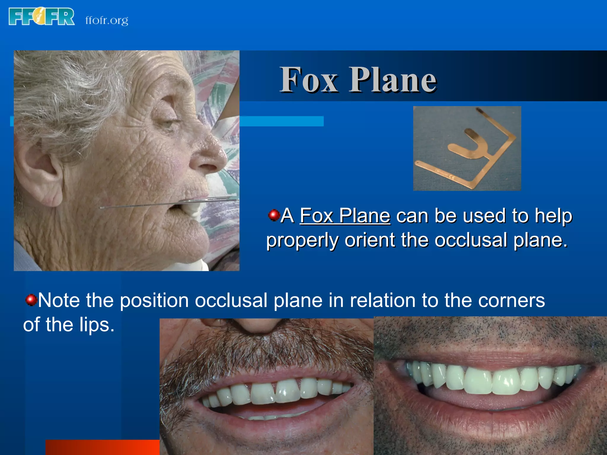 10.maxillomandibular relation records | PPT