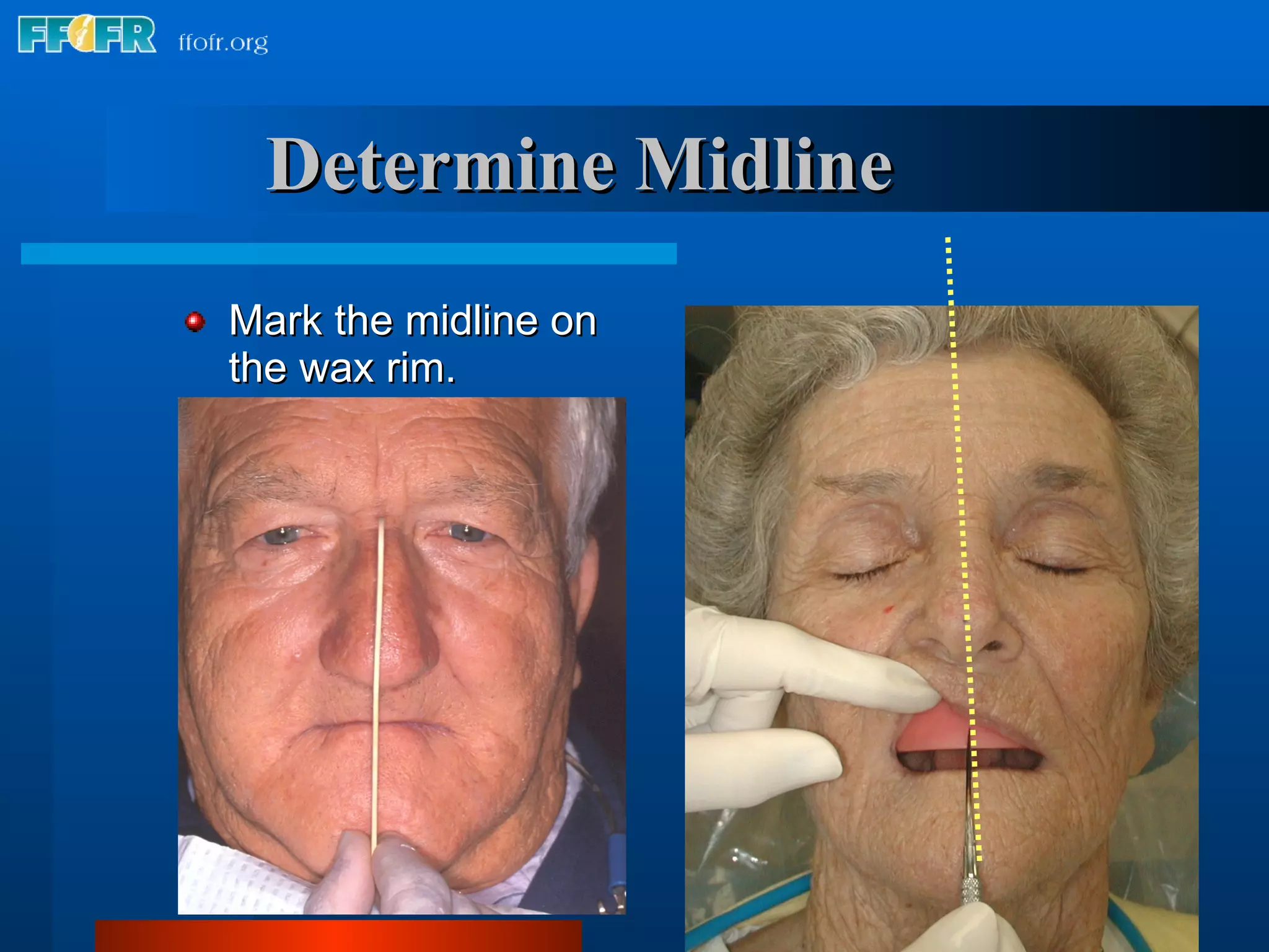 10.maxillomandibular relation records | PPT