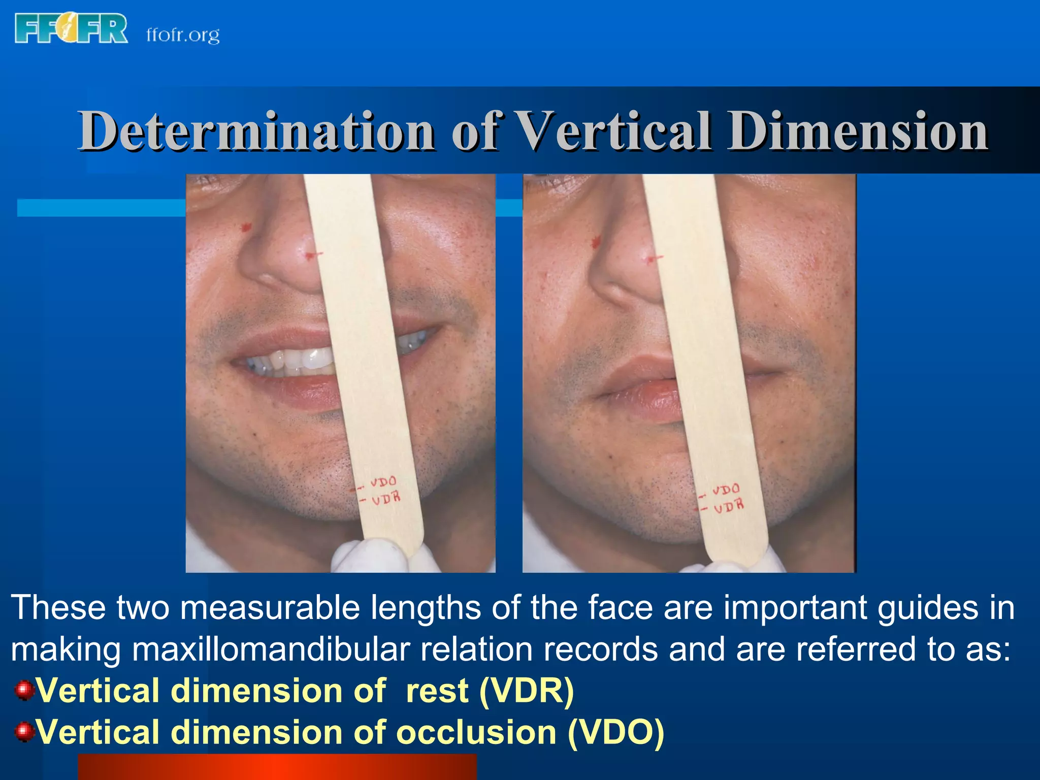 10.maxillomandibular relation records | PPT