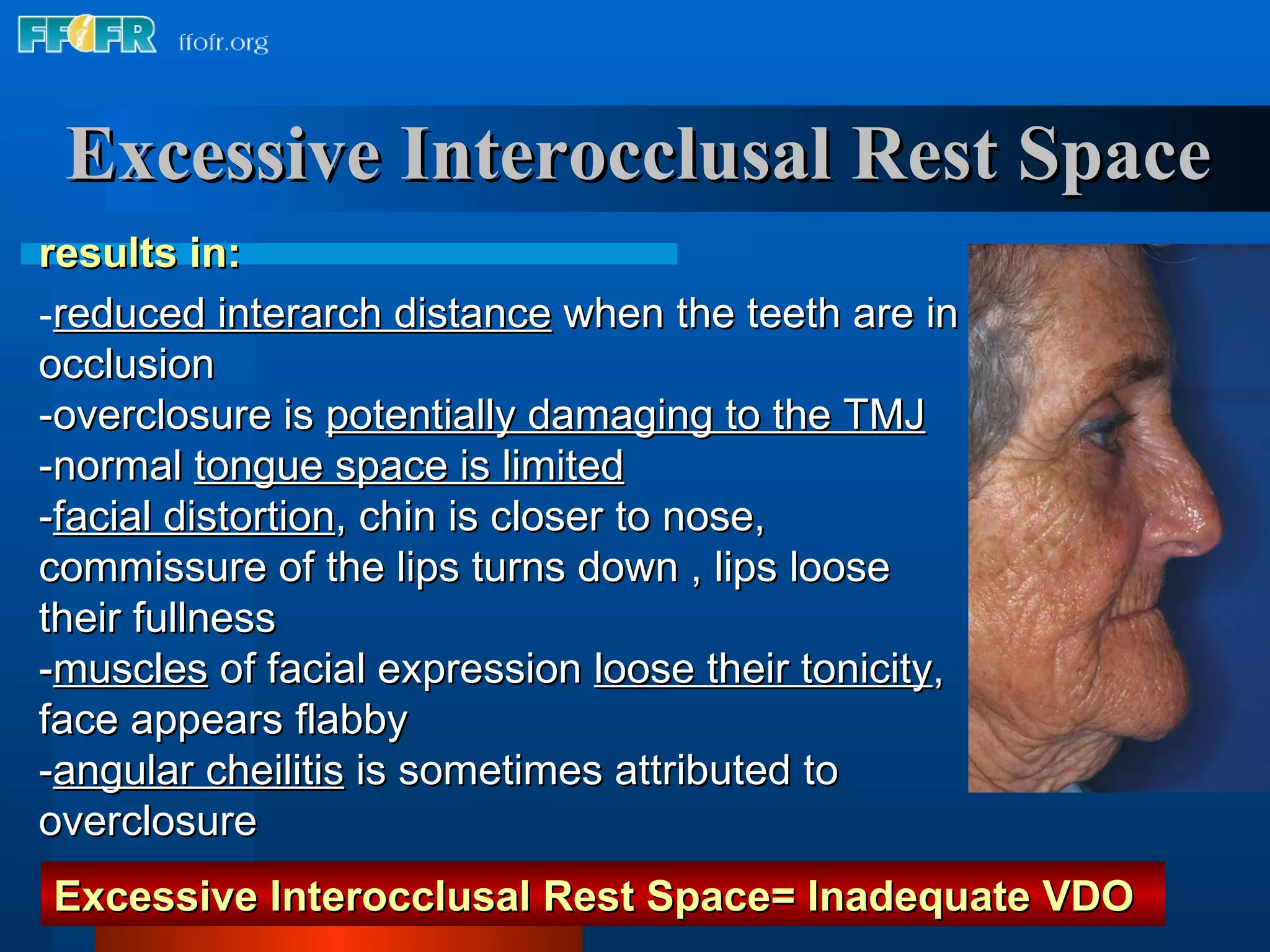 10.maxillomandibular relation records | PPT