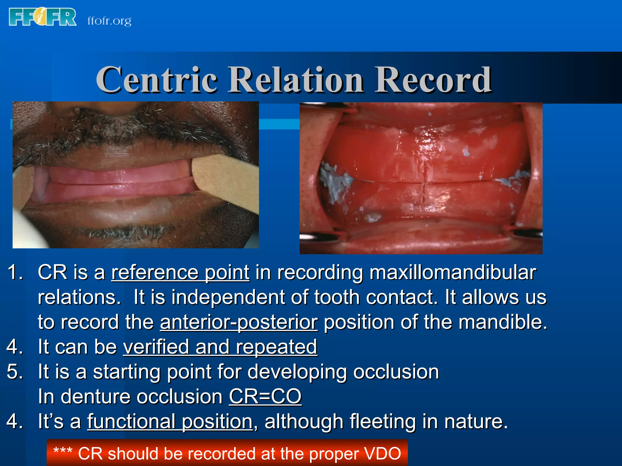 10.maxillomandibular relation records | PPT