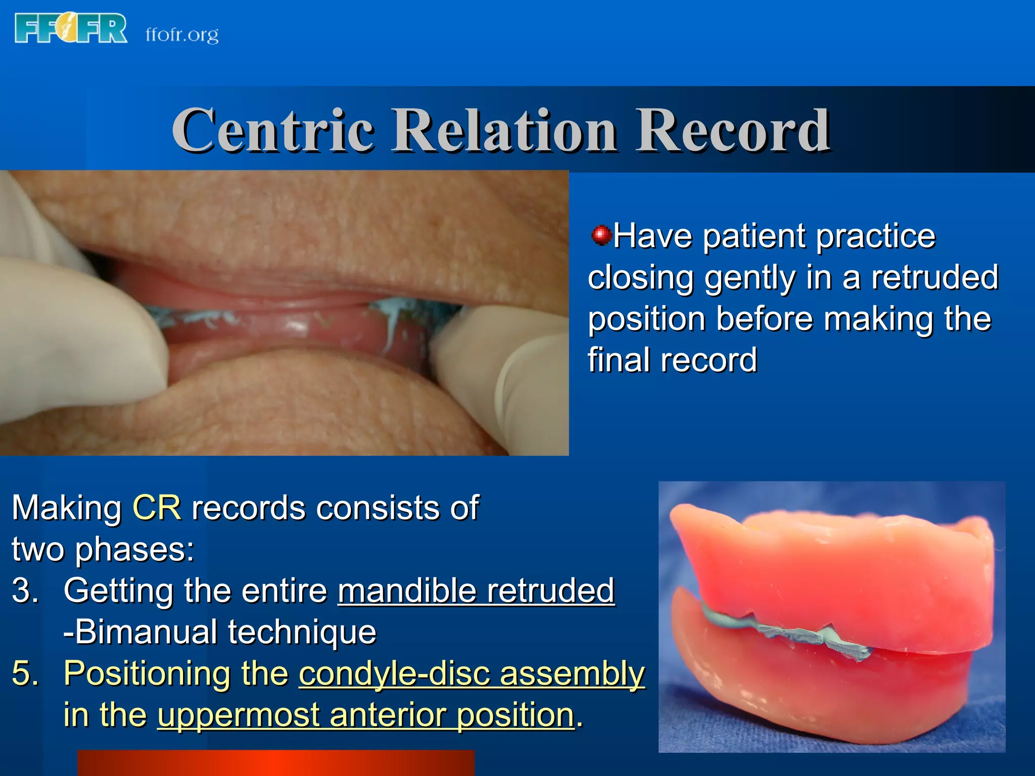 10.maxillomandibular relation records | PPT