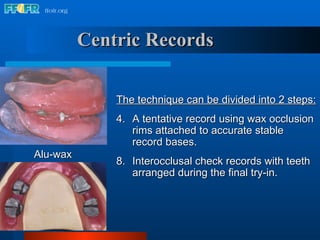 10.maxillomandibular relation records | PPT