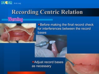10.maxillomandibular relation records | PPT