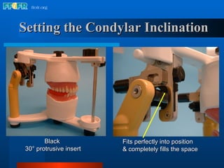 10.maxillomandibular relation records | PPT