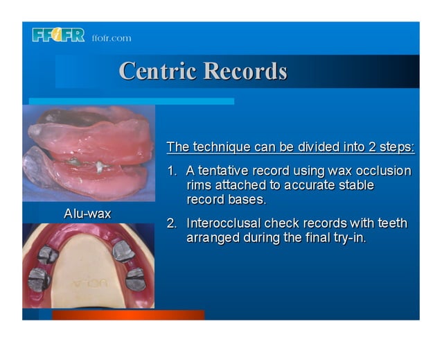10.maxillomandibular relation records | PPT