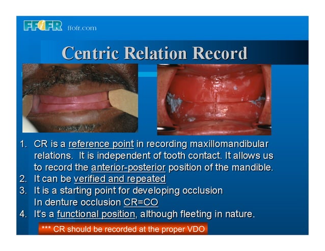 10.maxillomandibular relation records | PPT