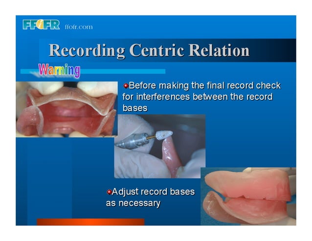 10.maxillomandibular relation records | PPT
