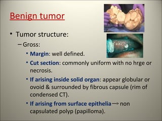 10 neoplasia | PPT