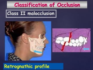 Occlusion | PPTX