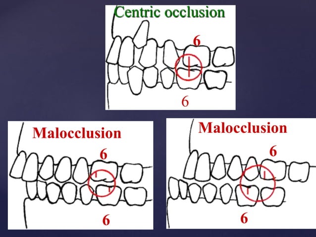 Occlusion | PPTX