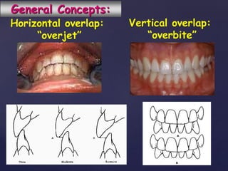 Occlusion | PPTX