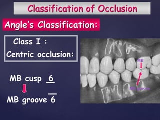 Occlusion | PPTX