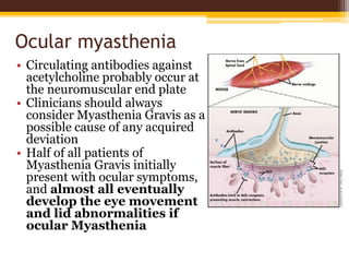 10-Ocular Myesthenia.pptx