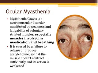 10-Ocular Myesthenia.pptx