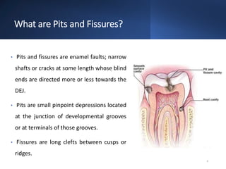 PIT AND FISSURE SEALANTS | PPTX | Oral care | Personal Care