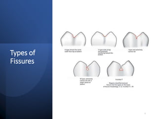 PIT AND FISSURE SEALANTS | PPTX