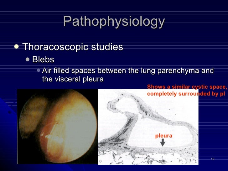 10.Pneumothorax
