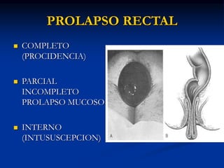 10- PROLAPSO RECTAL I.ppt