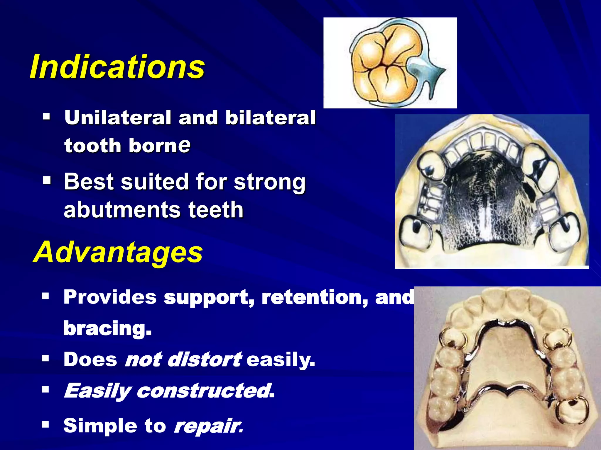 B- Retention of Removable Partial Dentures | PPT