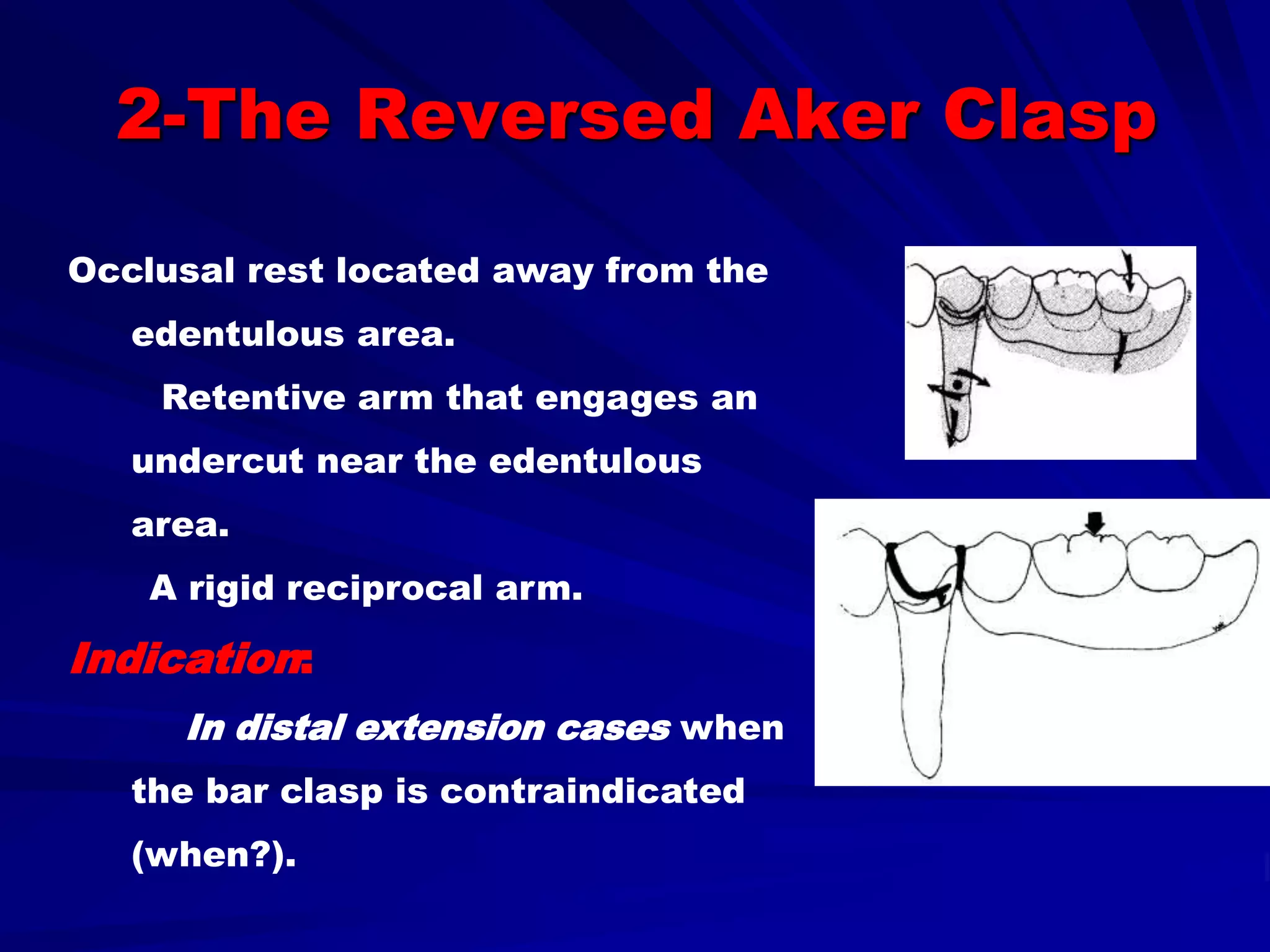 B- Retention of Removable Partial Dentures | PPT