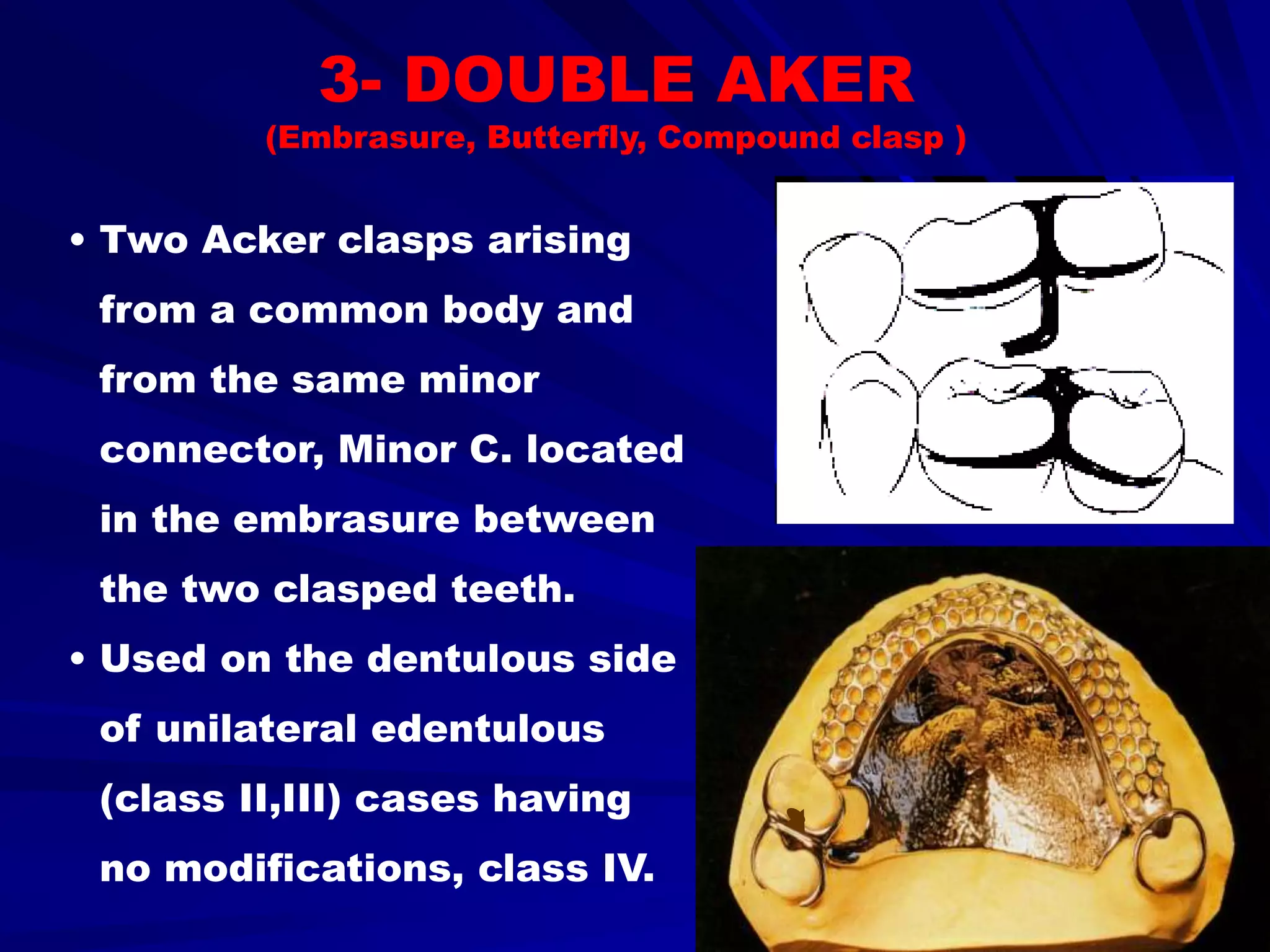 B- Retention of Removable Partial Dentures | PPT