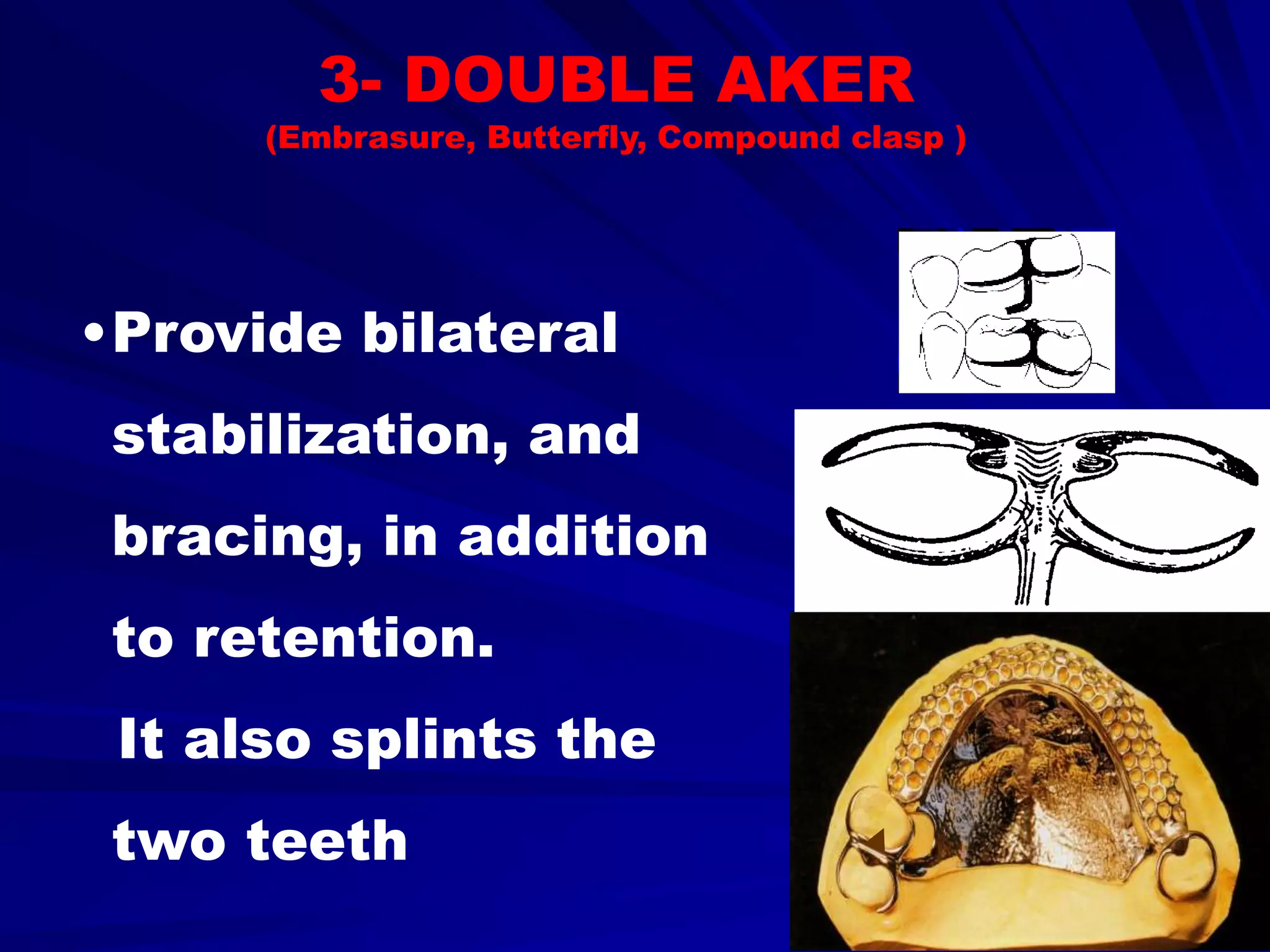 B- Retention of Removable Partial Dentures | PPT