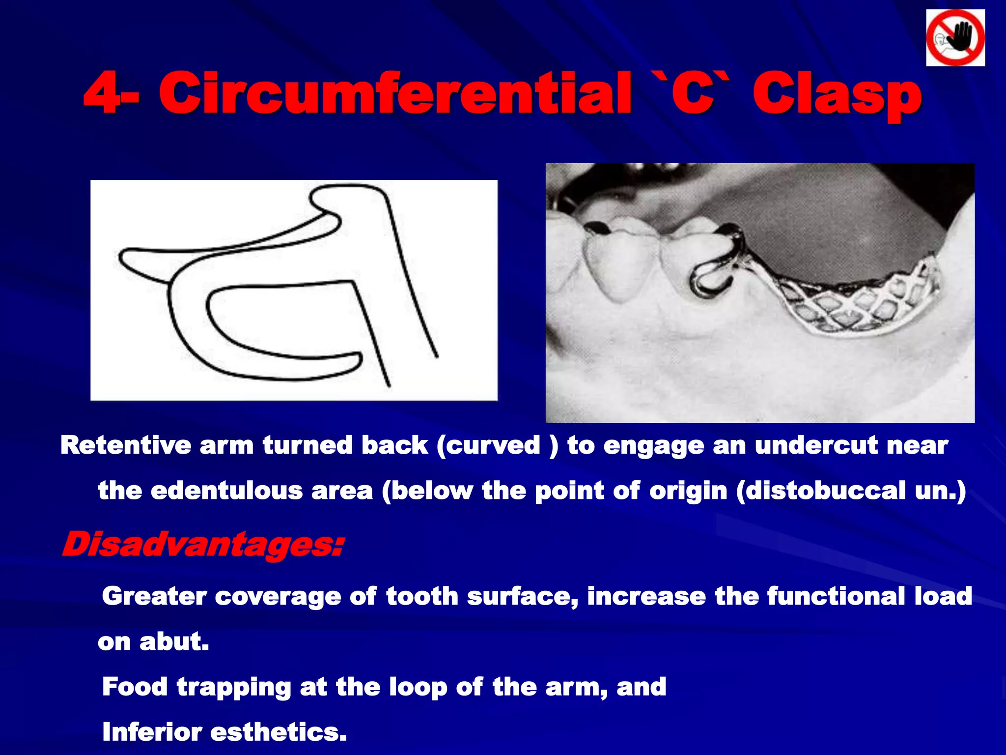 B- Retention of Removable Partial Dentures | PPT