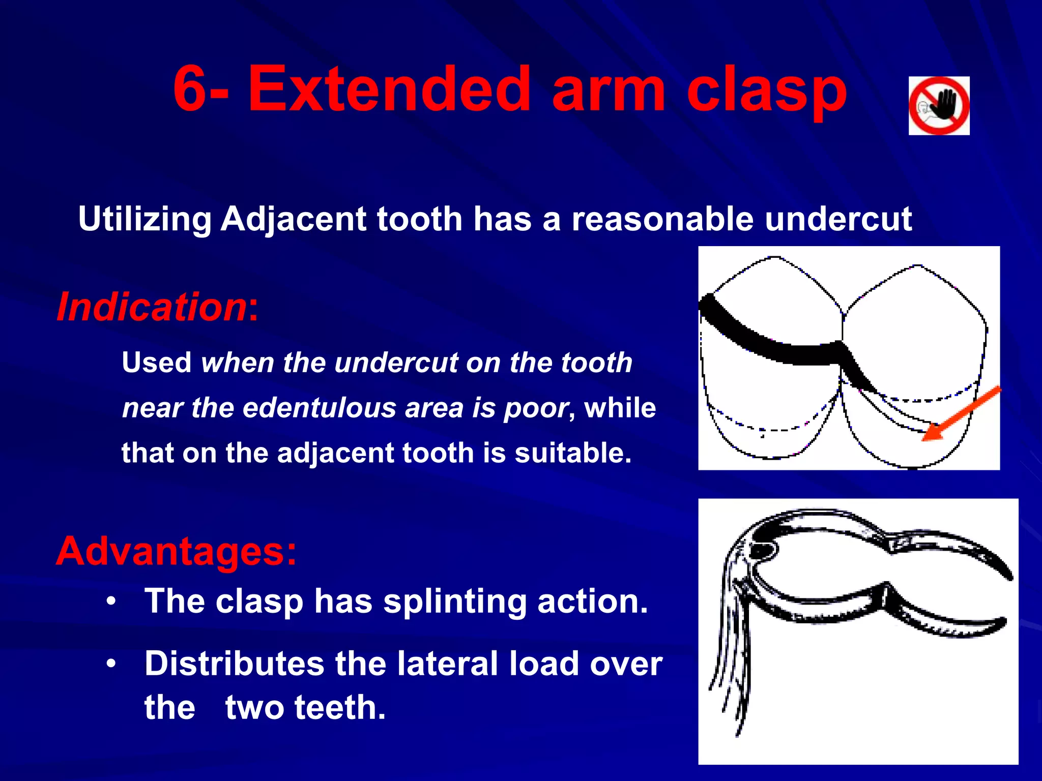 B- Retention of Removable Partial Dentures | PPT
