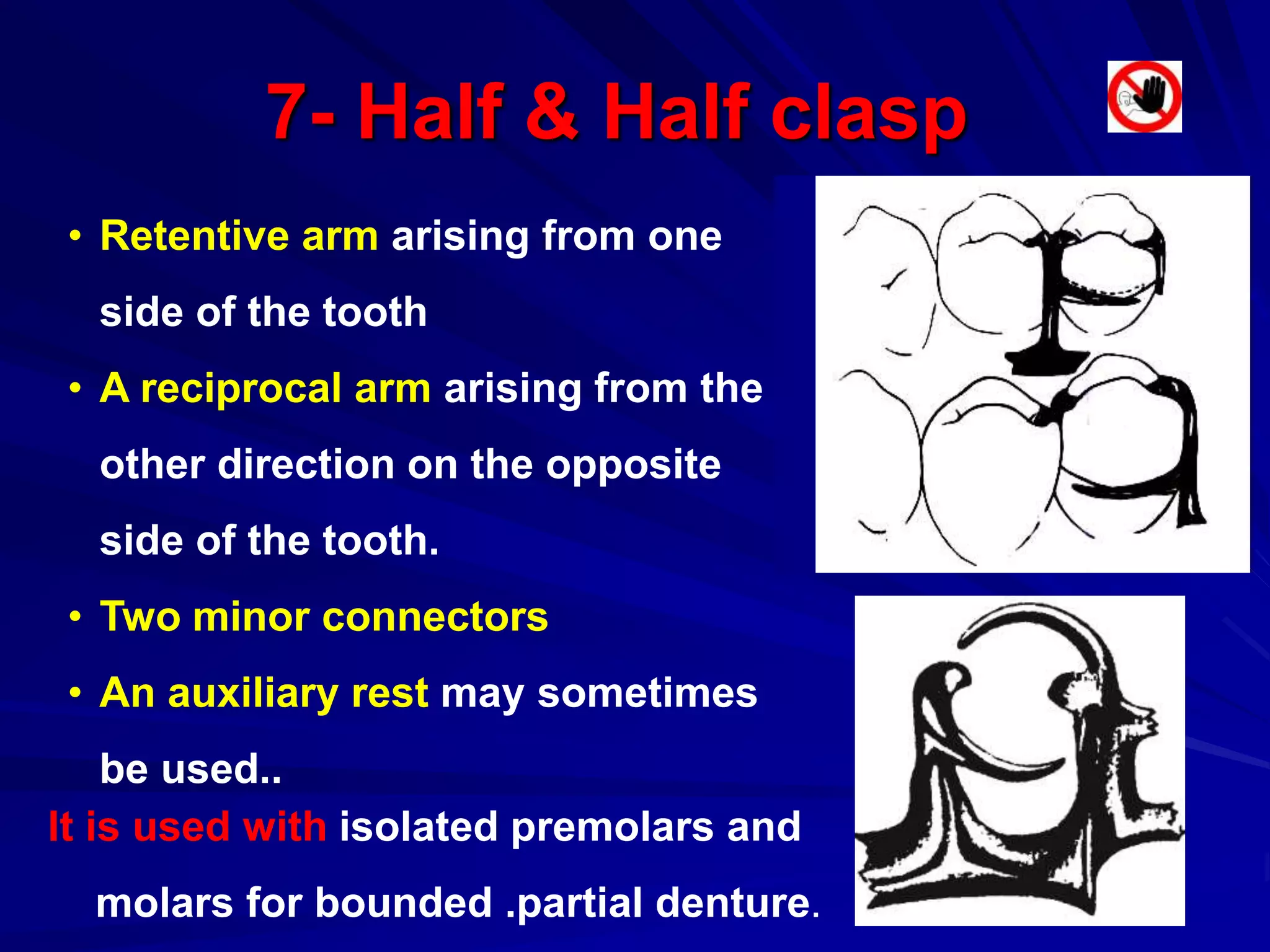 B- Retention of Removable Partial Dentures | PPT