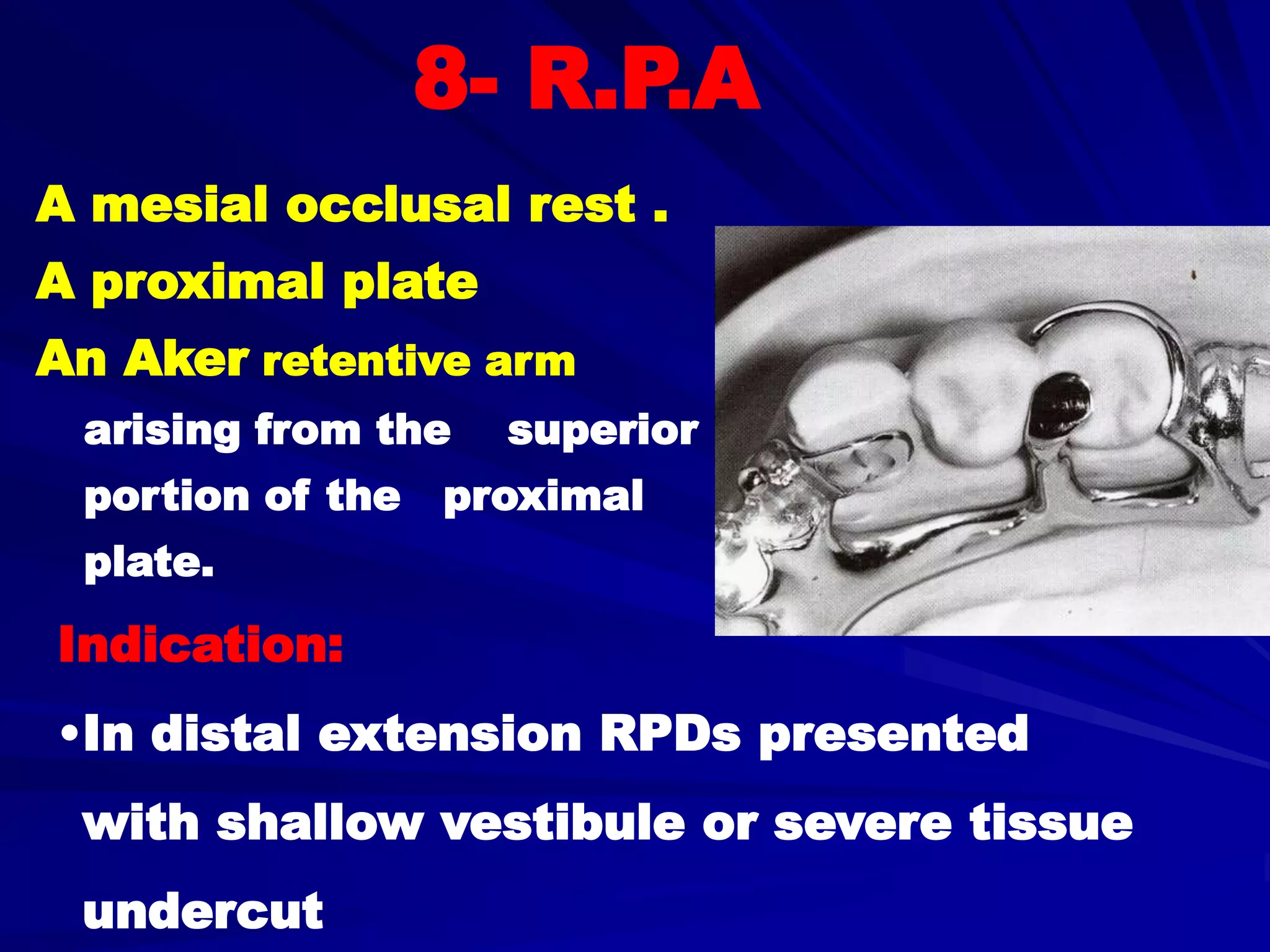 B- Retention of Removable Partial Dentures | PPT