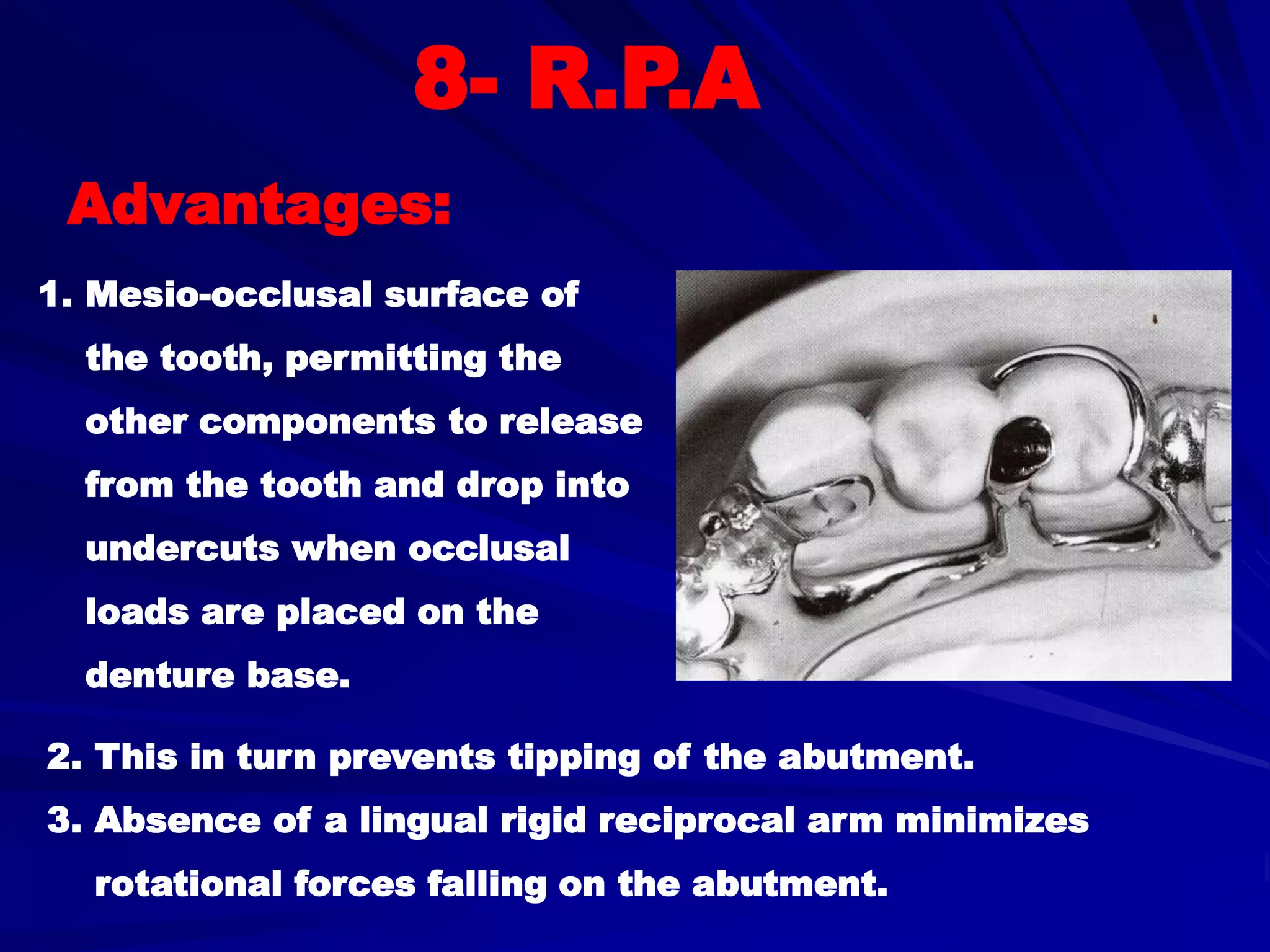 B- Retention of Removable Partial Dentures | PPT