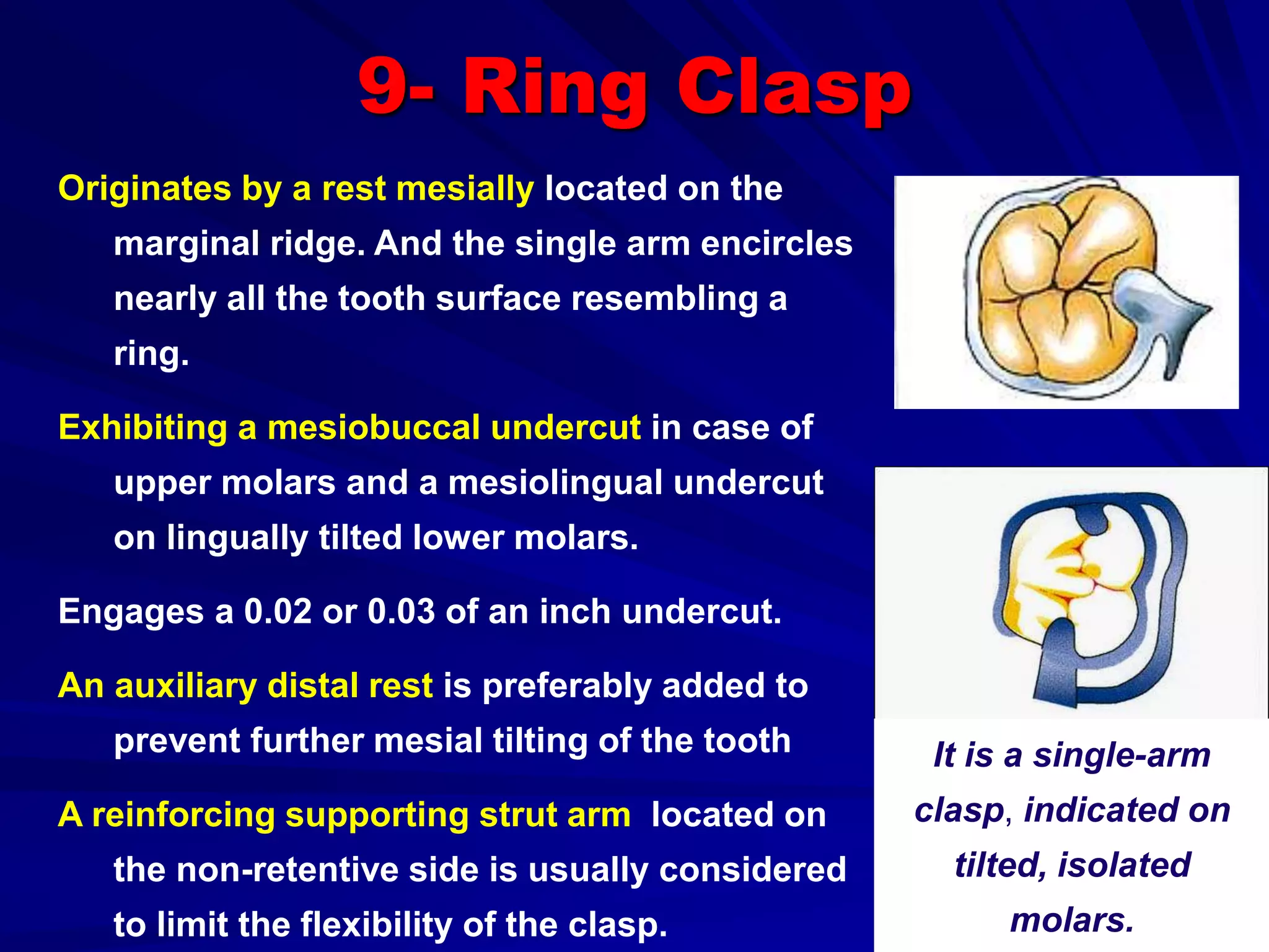B- Retention of Removable Partial Dentures | PPT